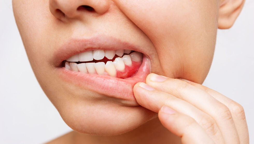 Beyond Bleeding Gums: Understanding the Early Stages of Periodontal ...